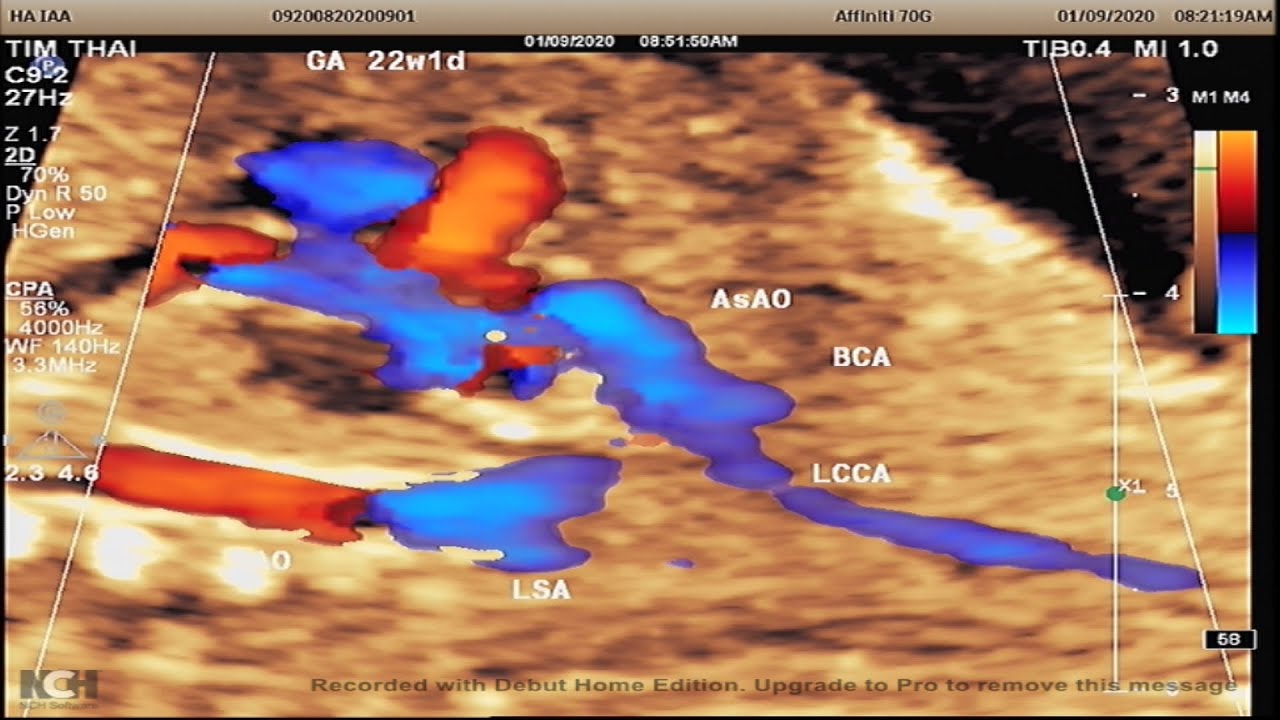 Fetus 22w, IAA type B, VSD, gián đoạn cung động mạch chủ type B - YouTube