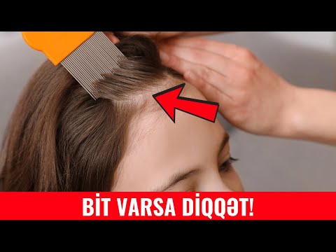 Uşağın başına bit düşərsə nə etmək lazımdır?