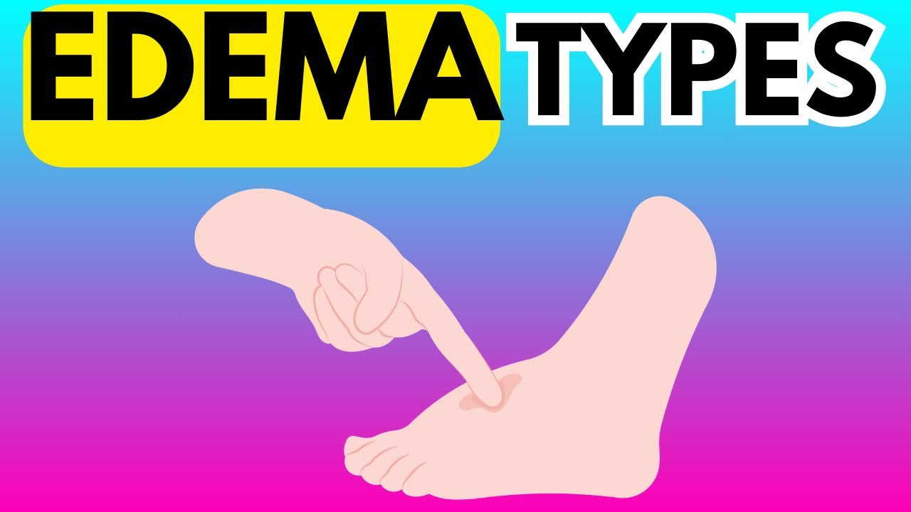 DIFFERENT TYPES OF EDEMA - TRANSUDATE VS EXUDATE - YouTube