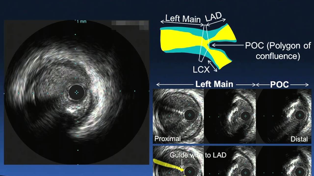 Left Main Bifurcation Lesion - YouTube