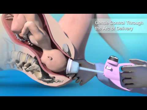 Vacuum Assisted Delivery featuring MityOne®