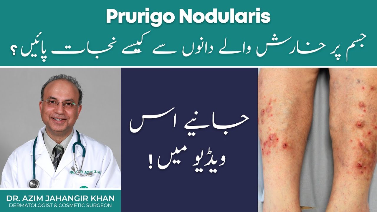 What is Prurigo Nodularis (Itchy Bumps -Skin Disease )| Cosmetique - YouTube