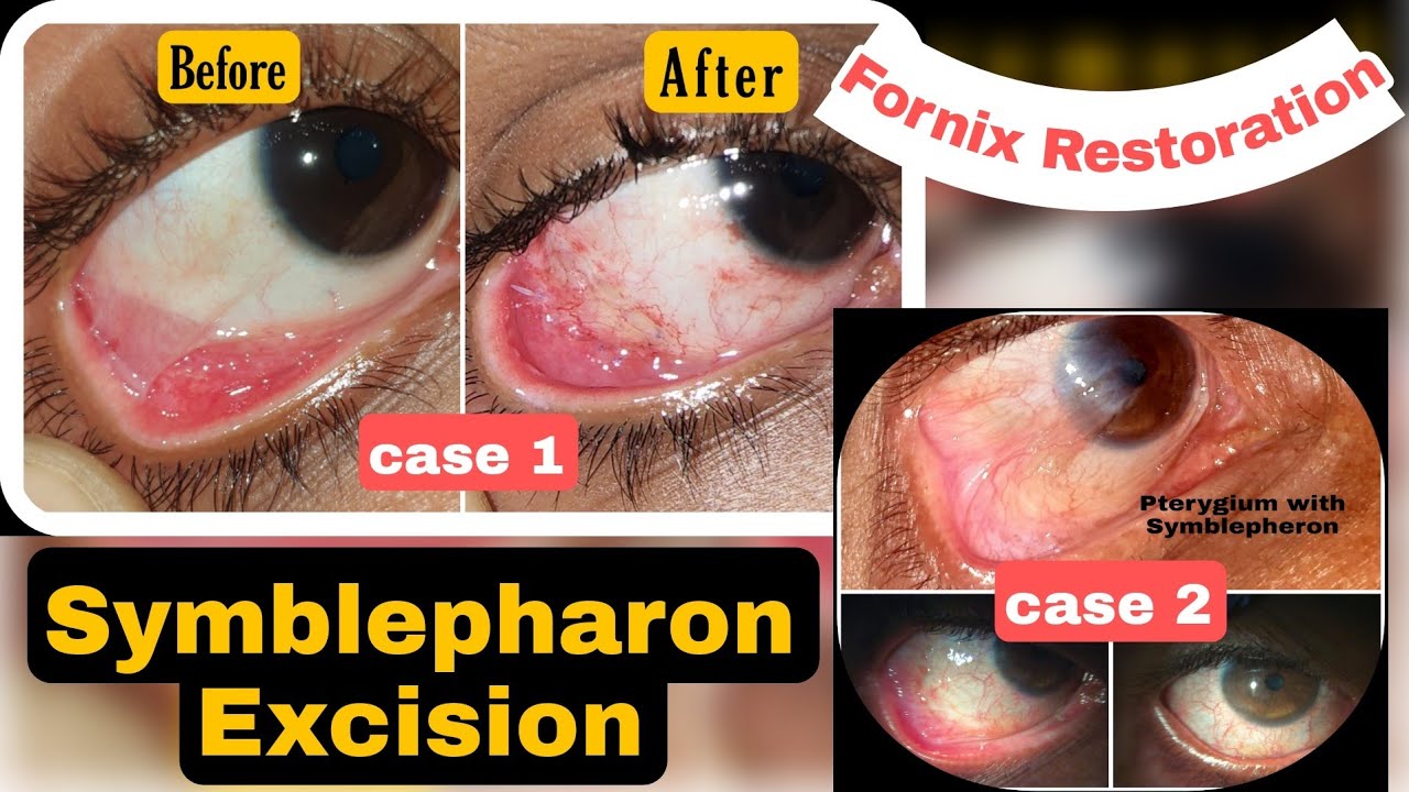 #115 Fornix reconstruction + Symblepharon excision using conjunctival ...