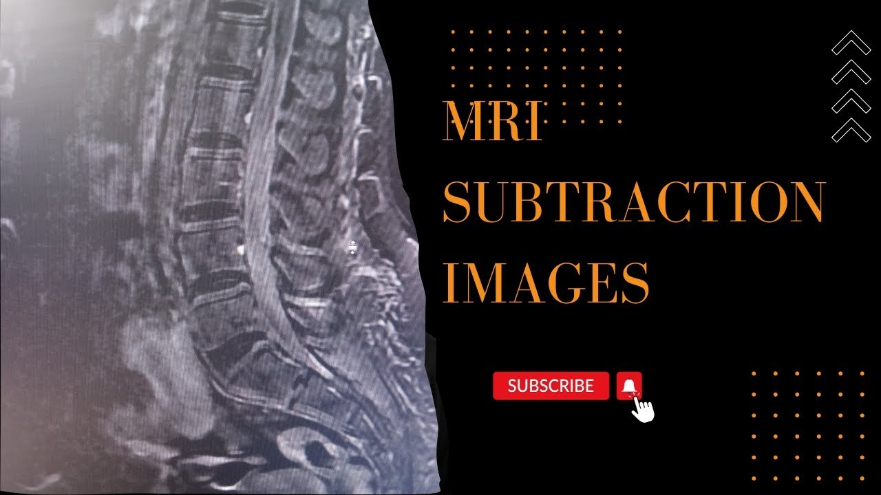 #Mri Ge 1.5t pe subtraction images kaese banae - YouTube