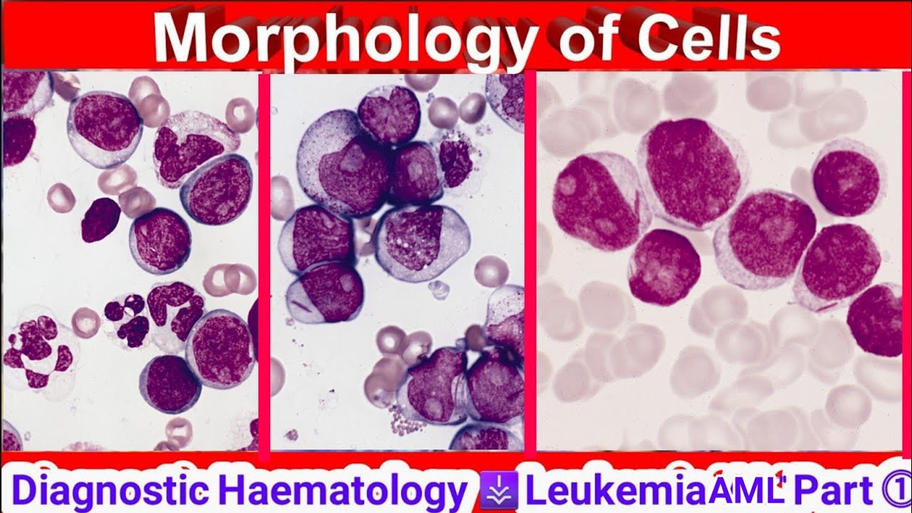 Hematology ⚶ Leukemia AML Morphology #HD - YouTube