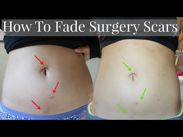 Open Appendectomy Scar Any Advice For Surgery Scar?