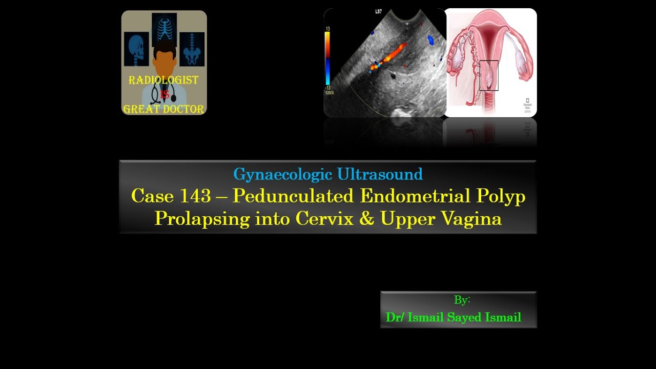 Ultrasound Case 143 Pedunculated Prolapsed Endometrial Polyp Youtube