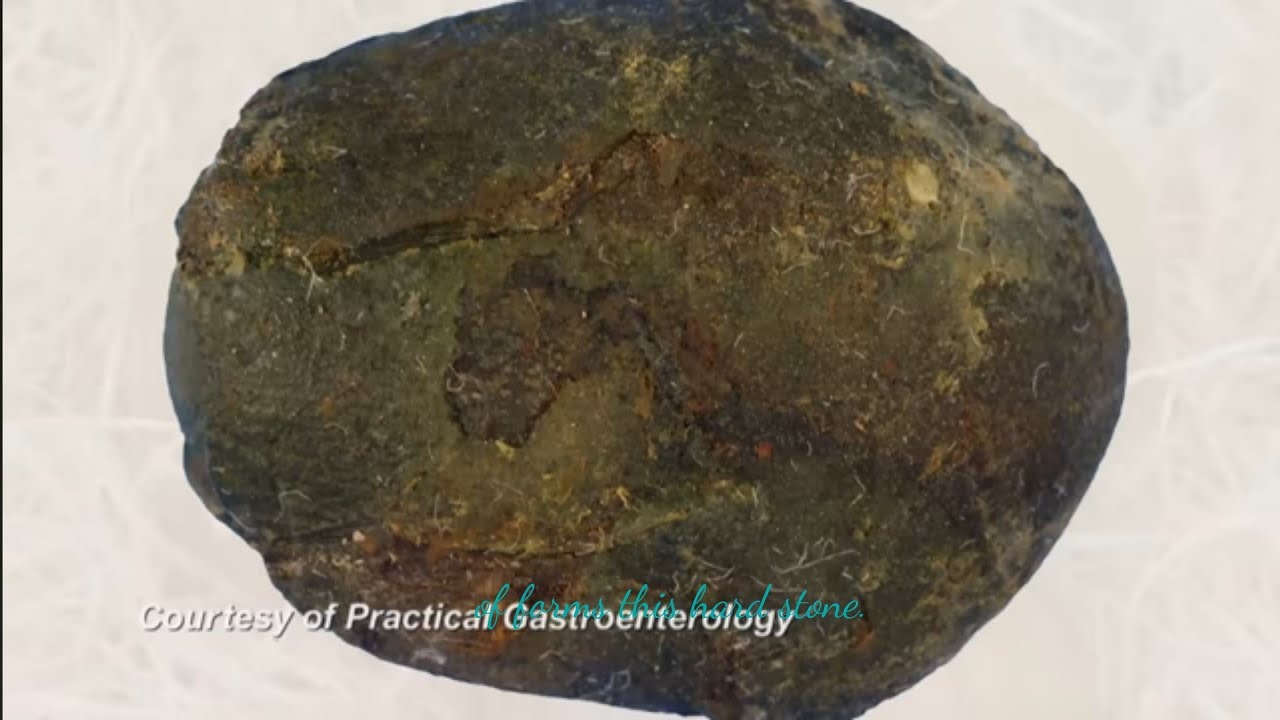 Dr G Medical Examiner enterolith and graves' disease - YouTube