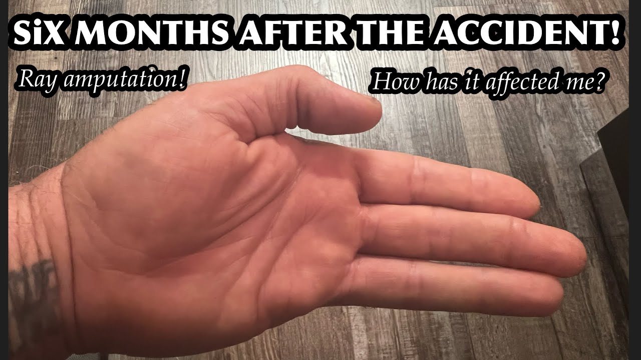 Ray amputation (6 month update). How has it changed my life? What ...