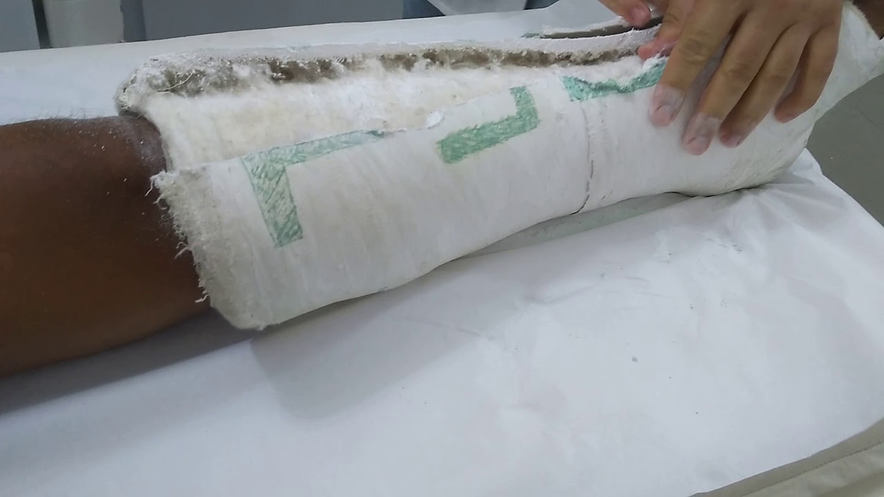 Tibia fraturada após 6 meses de gesso. - YouTube