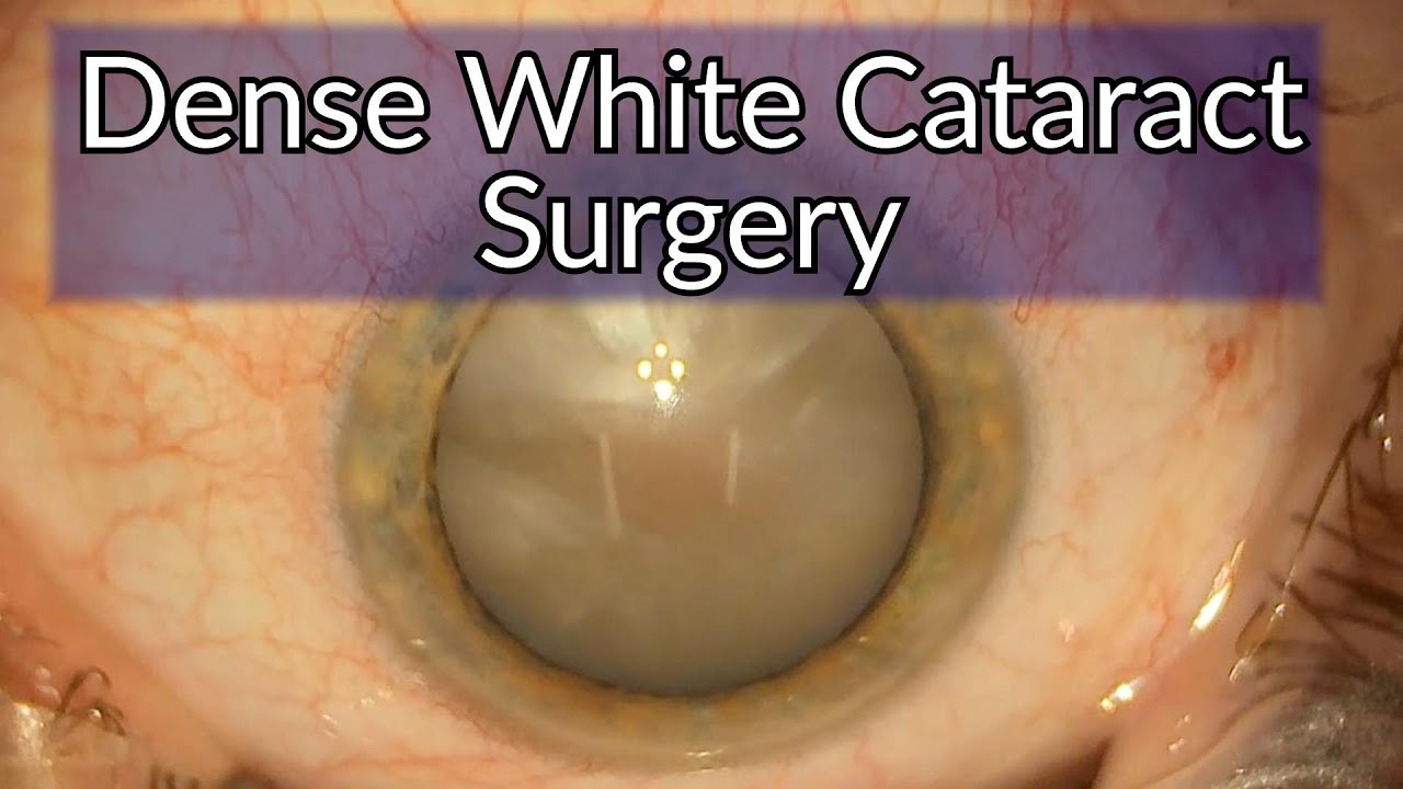 Dealing With White Cataract | Keep Calm and Don't Carry On - YouTube