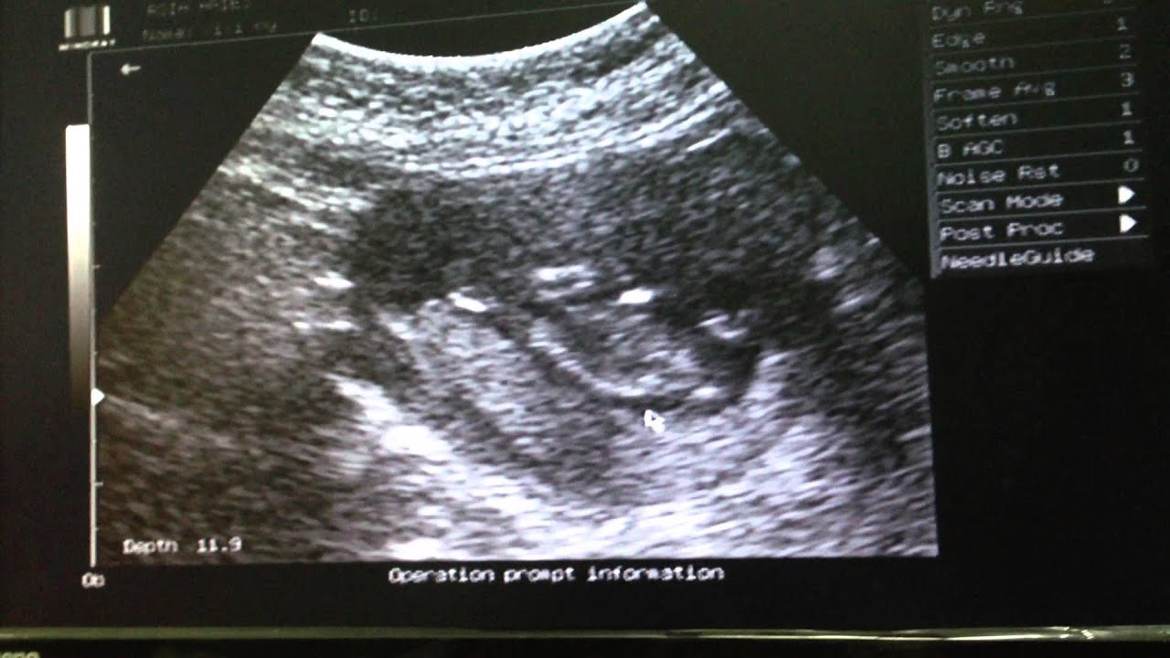 20130511 USG 12 week our baby-to-be - YouTube