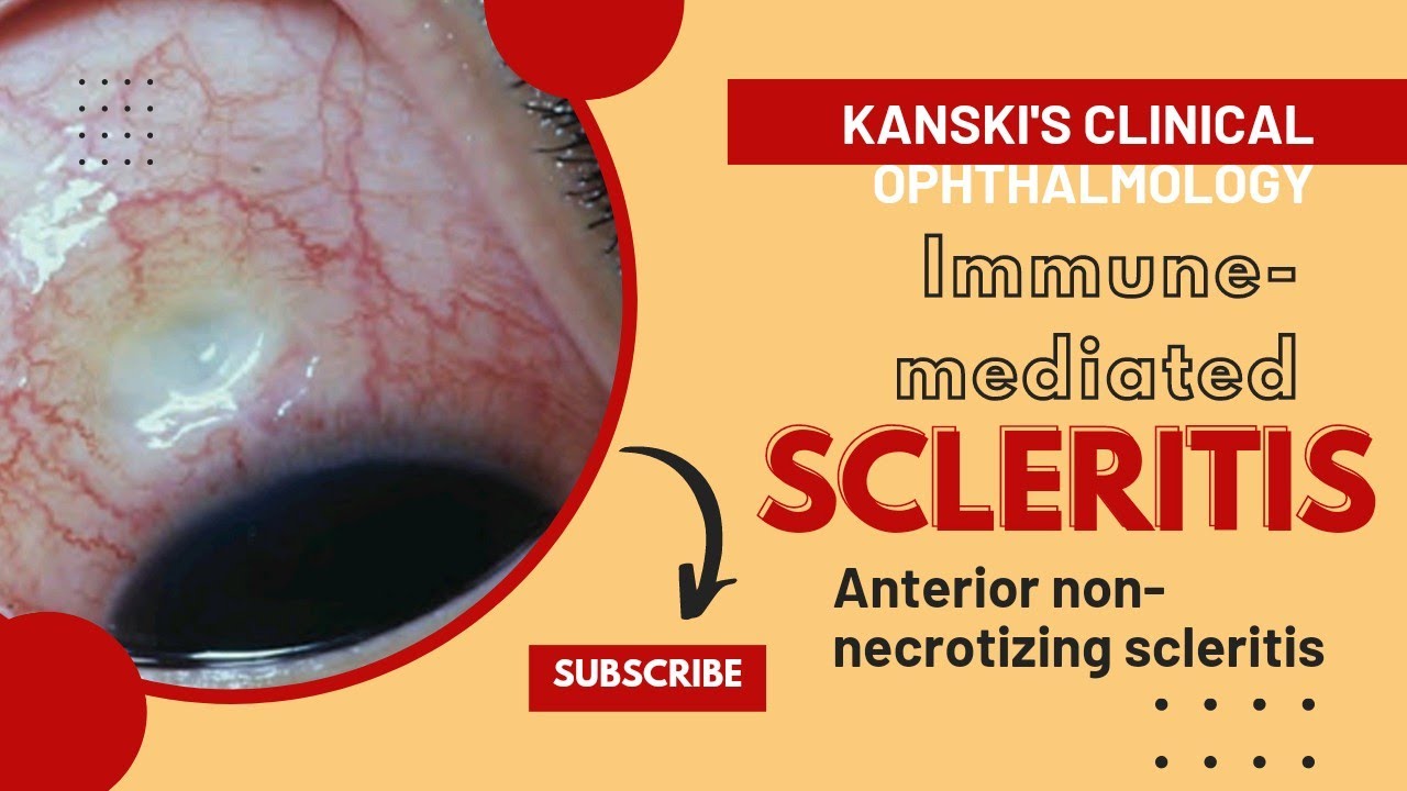 Immune-mediated scleritis-Kanski's clinical ophthalmology #scleritis # ...