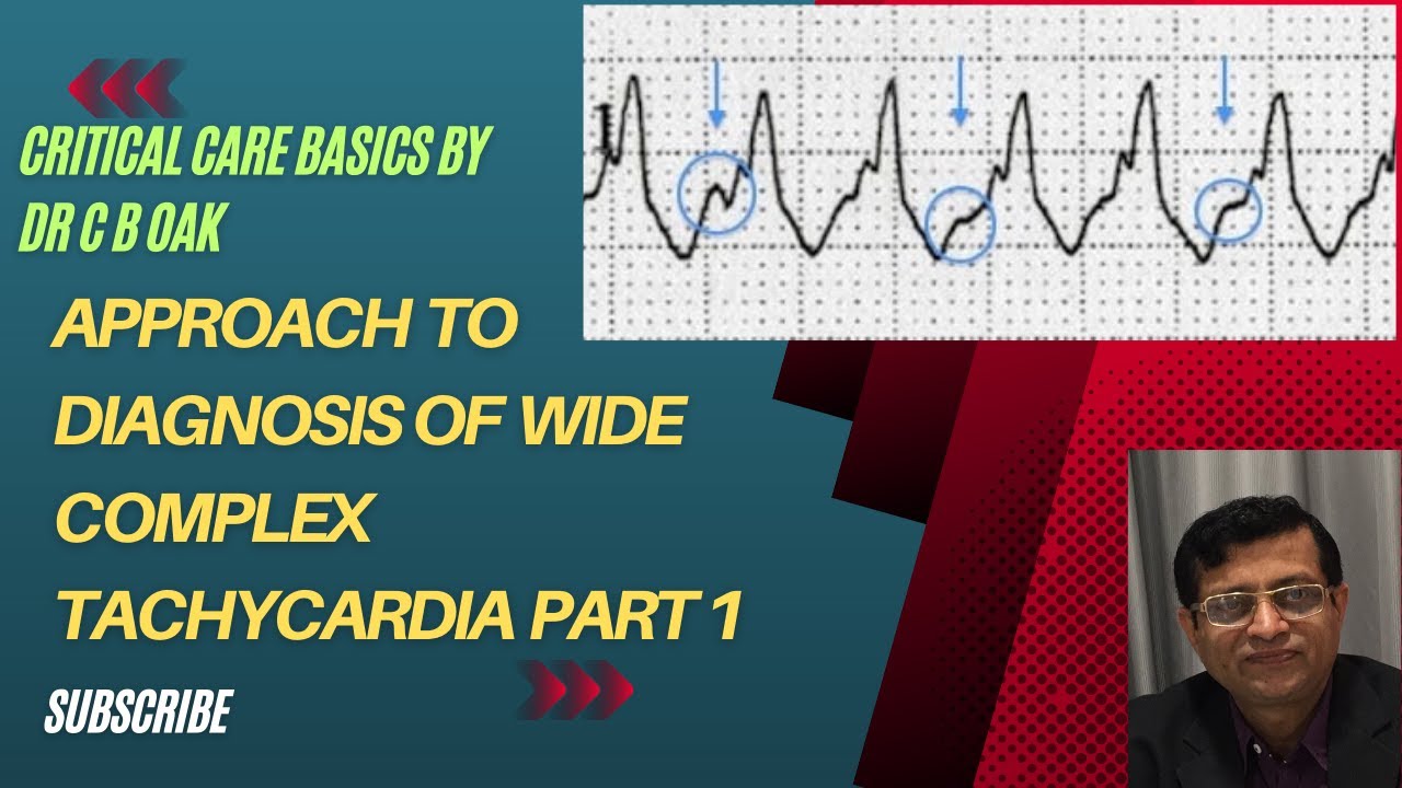ECG Tutorial 39 - Approach to diagnosis of Wide Complex Tachycardia ...