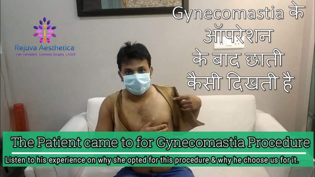 Gynecomastia Incredible Results are shown by patient himself. MUST ...