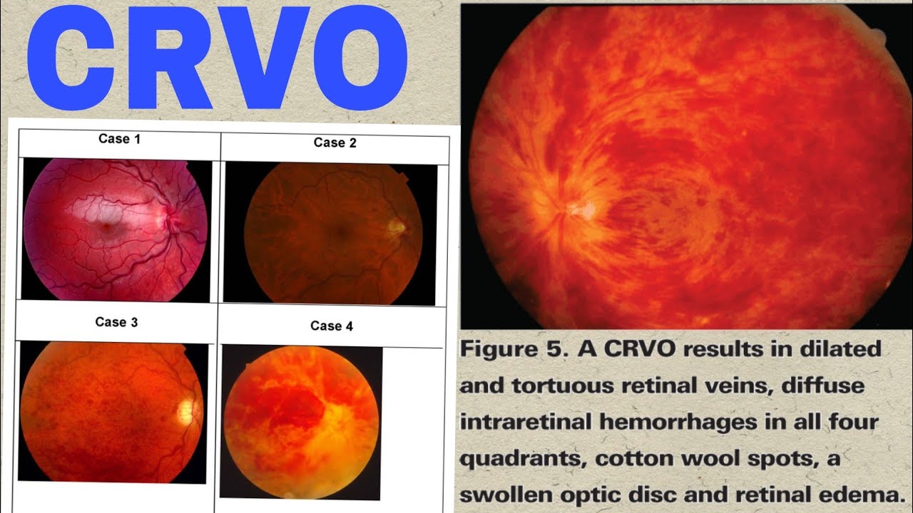 Hypertensive Retinopathy || Central Retinal Vein Occlusion... - YouTube