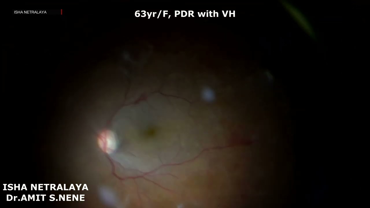 Vitrectomy for vitreous hemorrhage - YouTube