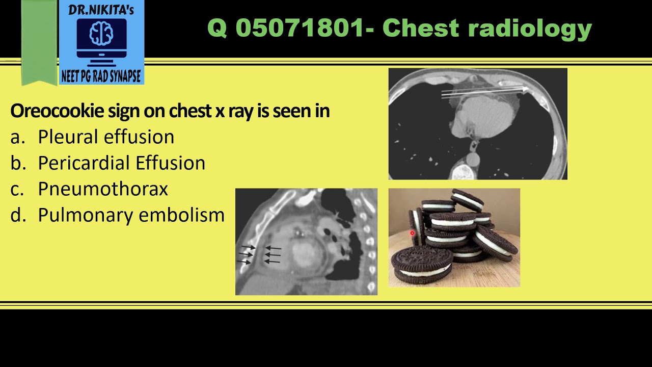 Oreocookie sign- Pericardial effusion - YouTube