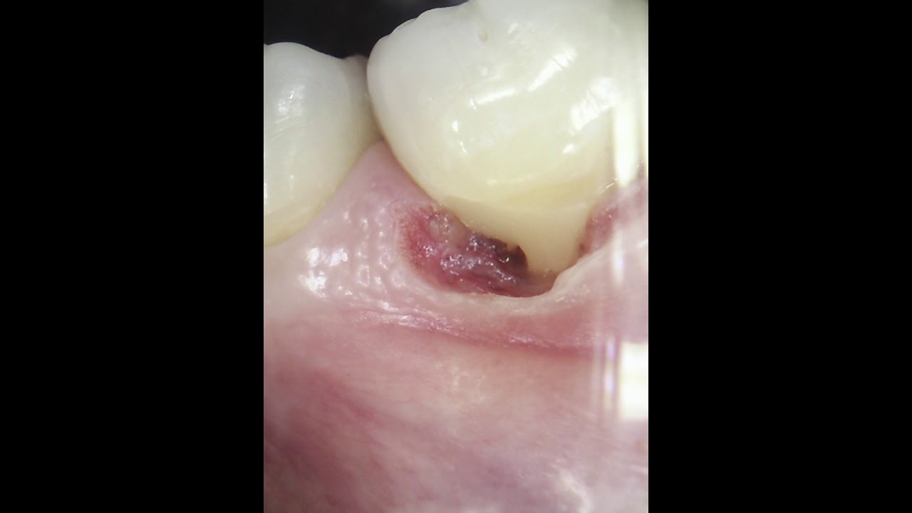 External Root Resorption Repair - YouTube