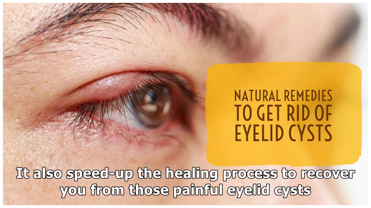 Natural Remedies to Get Rid of Eyelid Cysts - YouTube