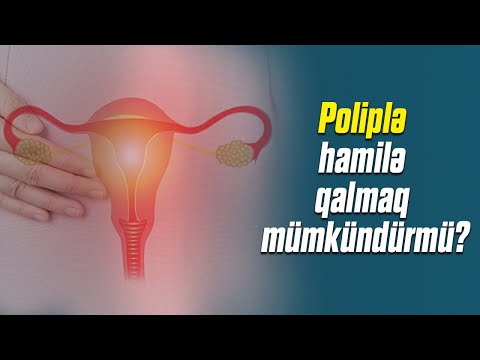 Poliplə hamilə qalmaq mümkündürmü? ( Cərrah mama ginekoloq Aynurə Nəcəfəliyeva )