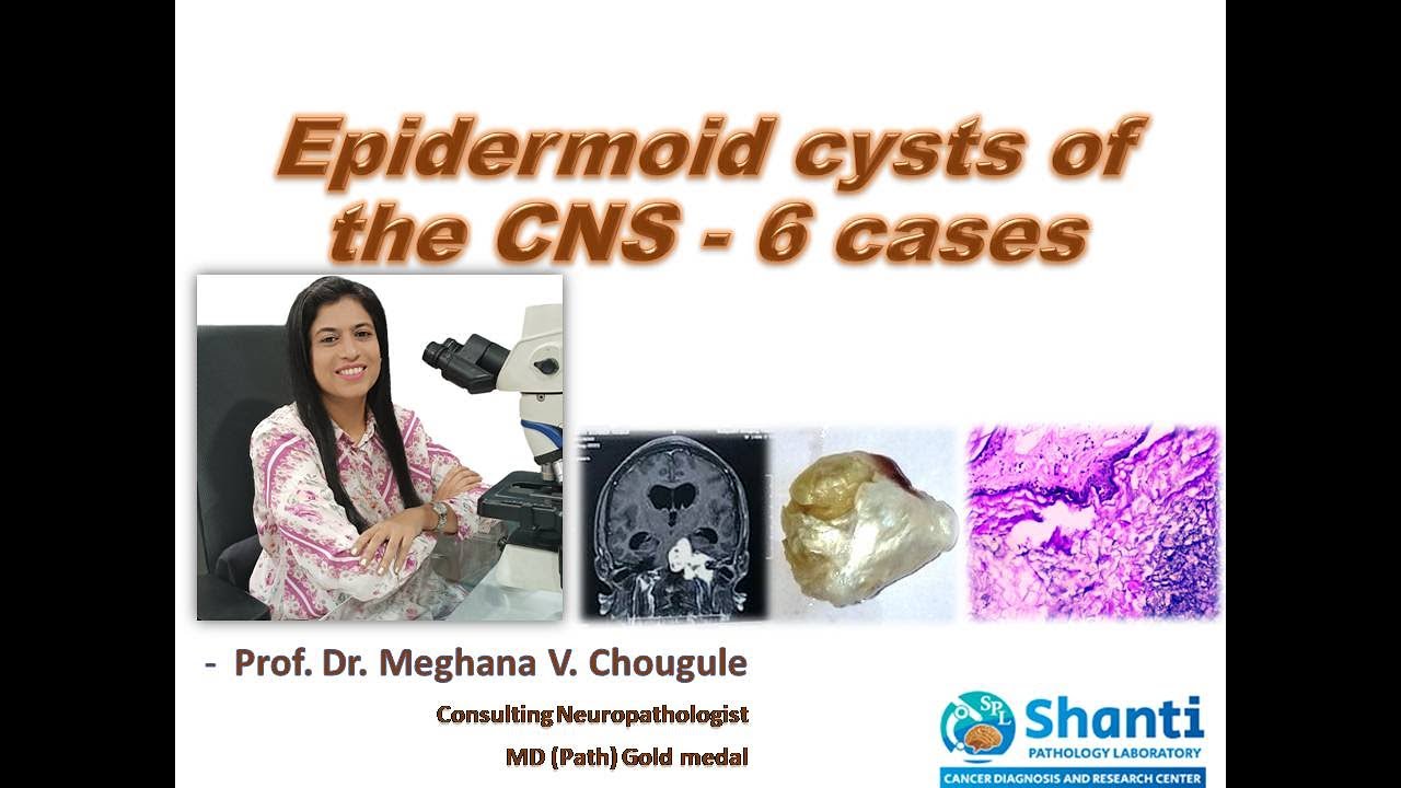 Epidermoid cysts of the CNS - 6 cases - YouTube
