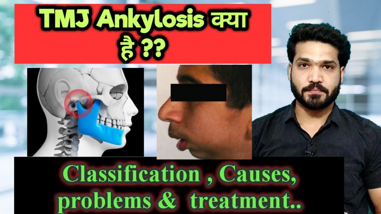 TMJ Ankylosis क्या है ? Classification, causes & treatment - YouTube