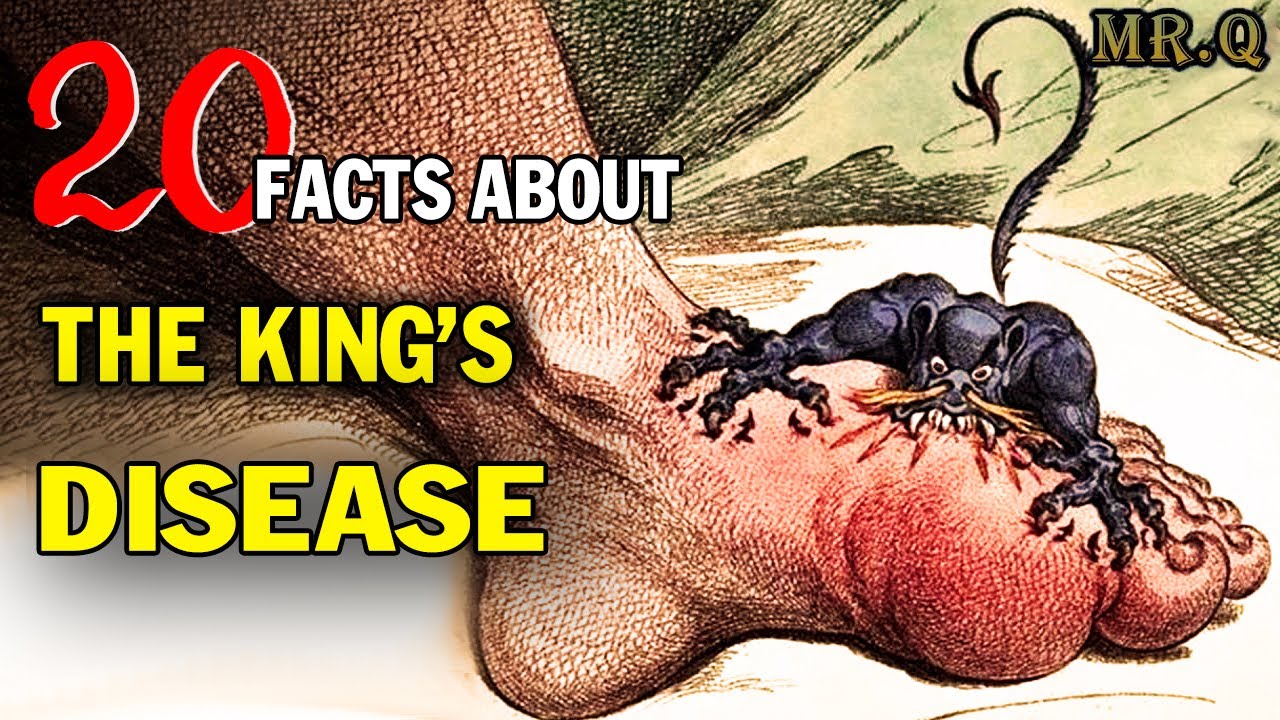 20 Weirdest Facts About The History of Gout | The DISEASE OF KINGS ...