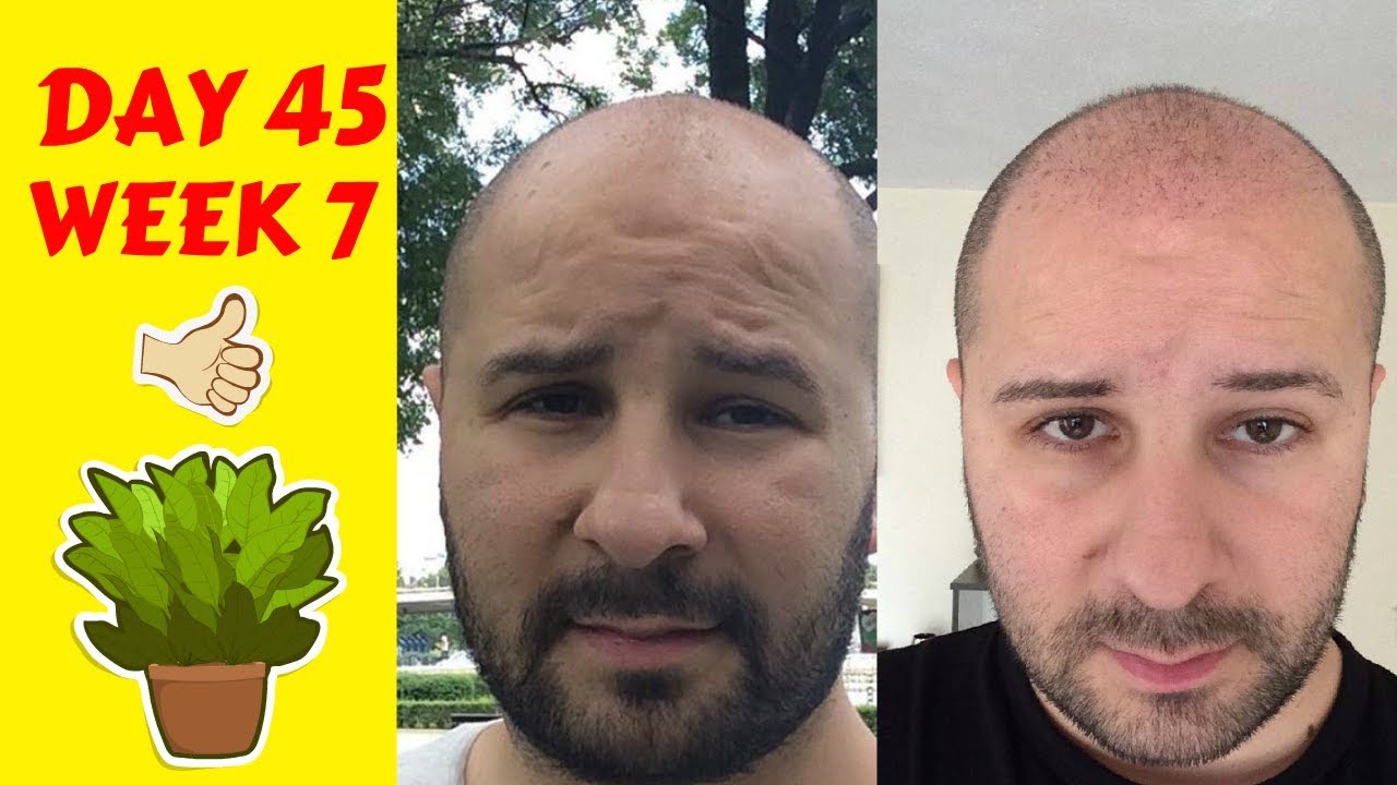 FUE Hair Transplant Timeline Day 0 to Day 45 - Results - Before and ...