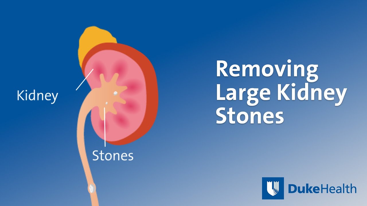 How to Treat Large Kidney Stones | Duke Health - YouTube