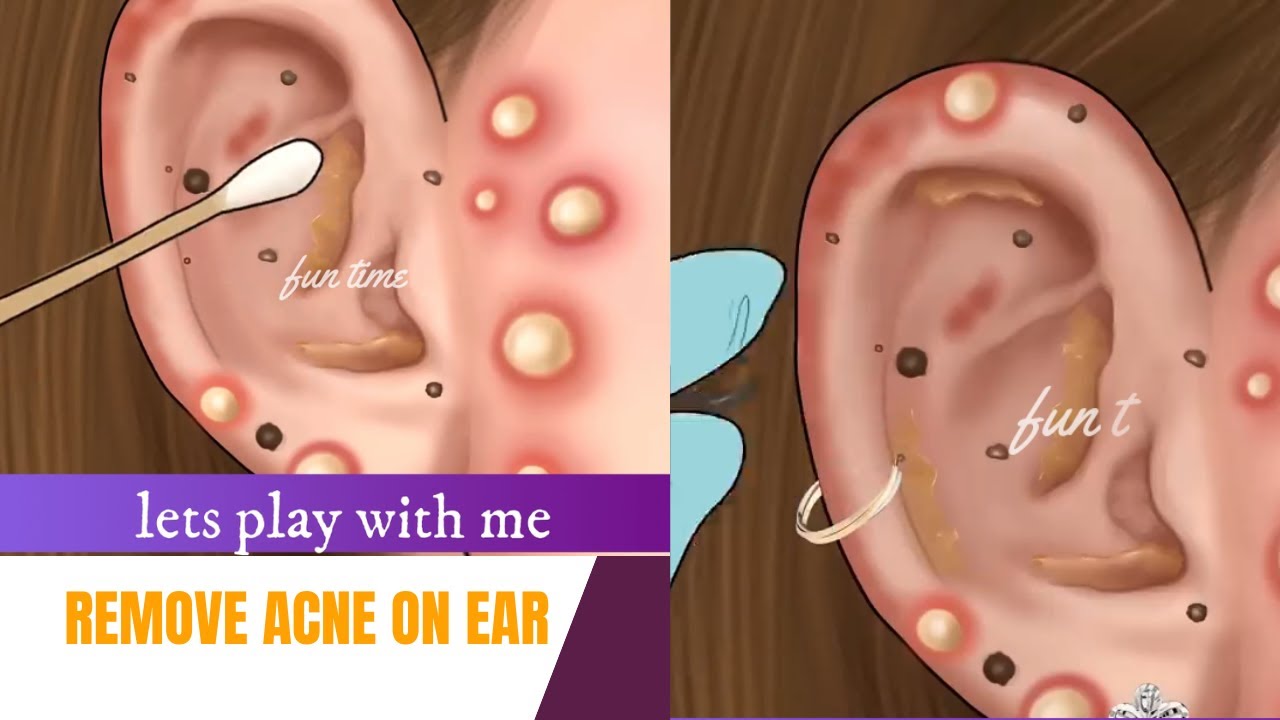 5 Simple Tips To Relax Your Ears & CLEAN Them Up/WOUNDS/POPPING ...