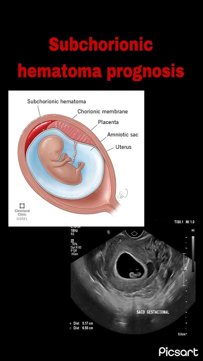 Subchorionic hematoma prognosis | Miscarriage rate following vaginal bleeding in pregnancy - YouTube