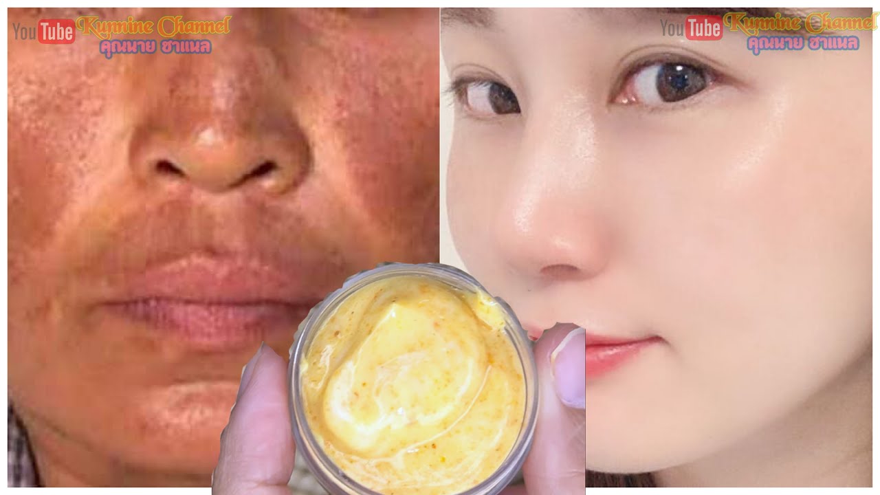 Magical Turmeric Cream🚩3 Day removes pigmentation, Dark spots, freckles ...