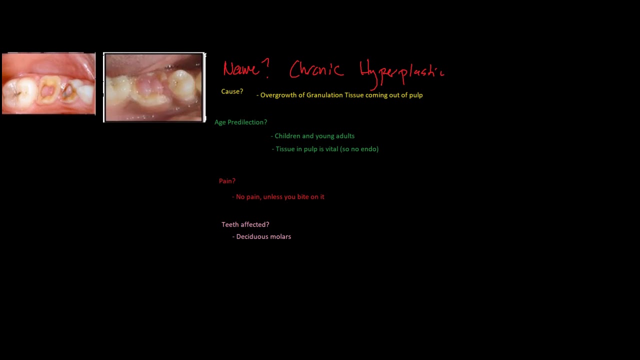 Chronic Hyperplastic Pulpitis - YouTube