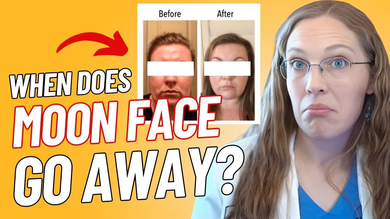 Moon Face from Prednisone: How Long Does It Take to Go Away? - YouTube