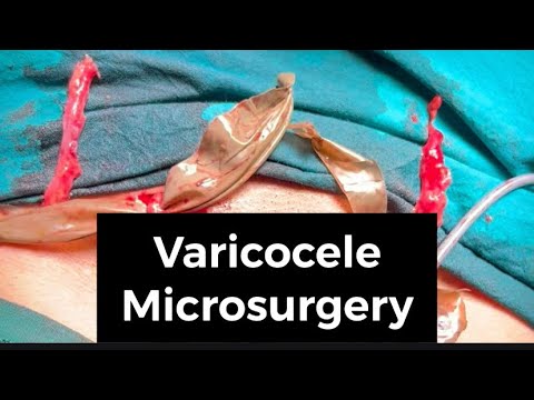 Micro surgery for #varicocele - YouTube