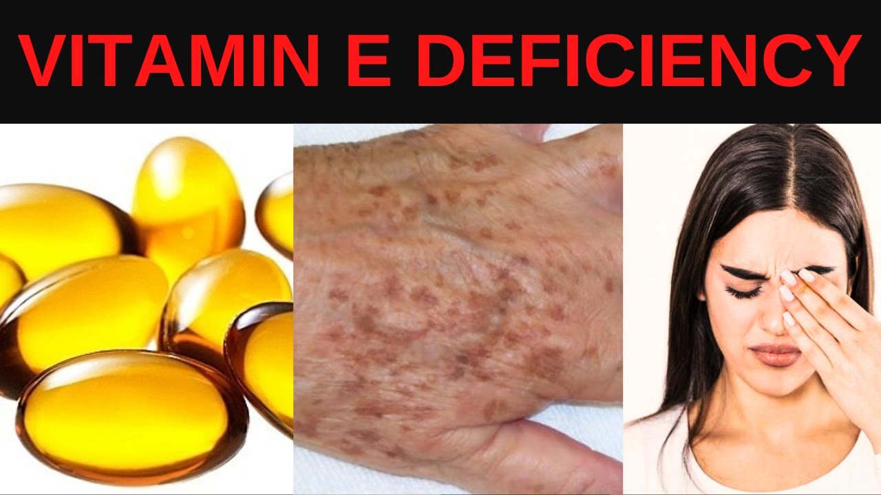 Vitamin E Deficiency Symptoms - YouTube