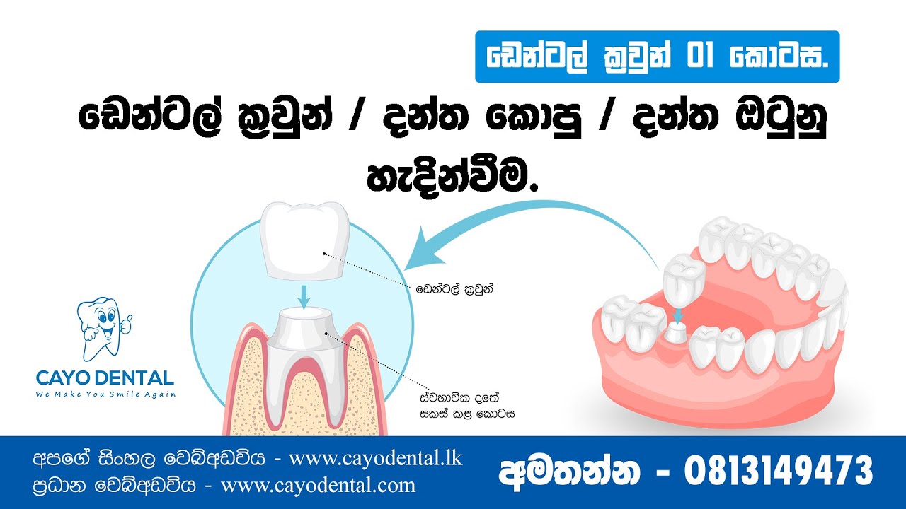 කැඩුණු දත් හදමු. ඩෙන්ටල් ක්‍රවුන් / දන්ත කොපු (Dental Crown Sinhala ...