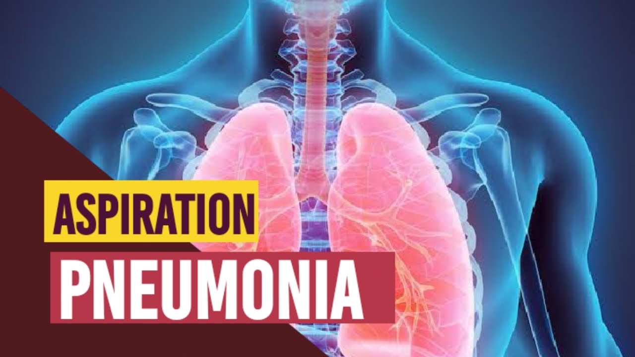 icu chest (6) aspiration pneumonia - YouTube