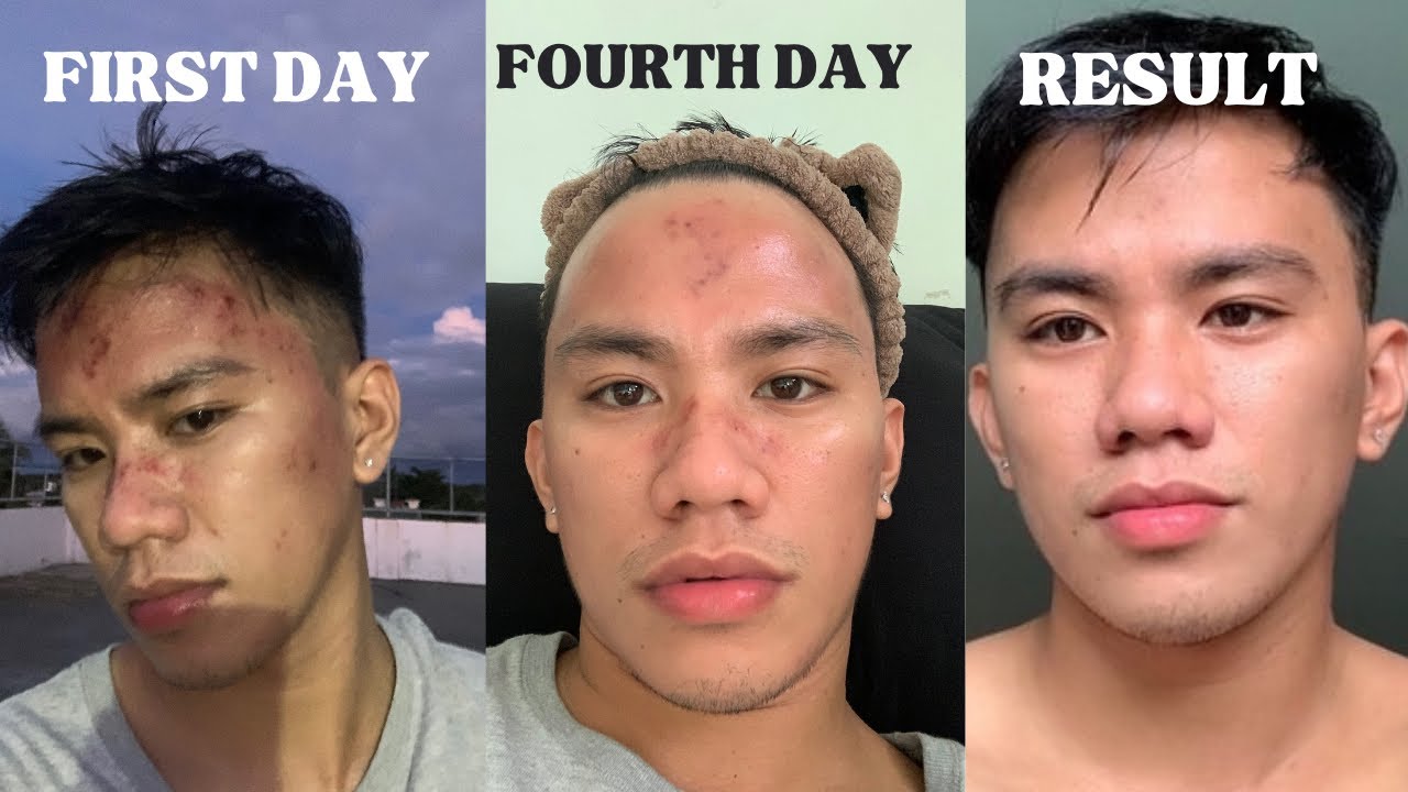 SOLUSYON PARA MAWALA ANG BUTAS SA MUKHA | ONE WEEK RESULT!! - YouTube