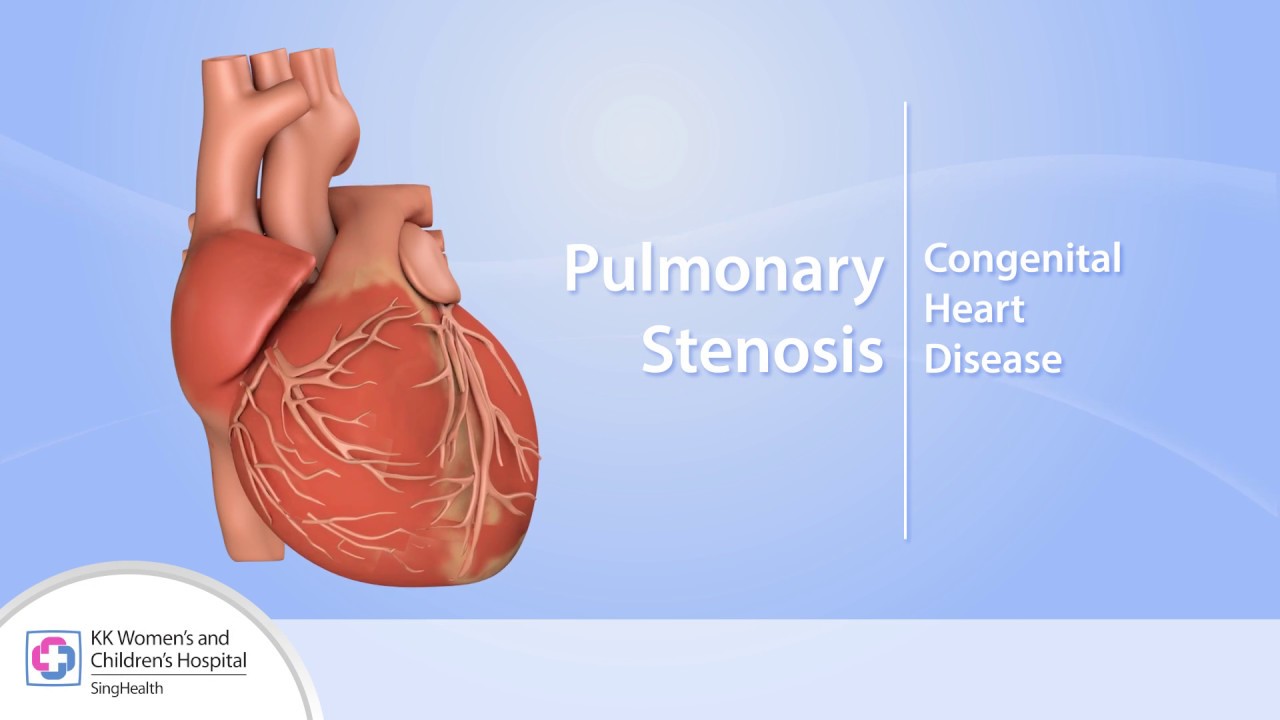 Pulmonary Valve Stenosis Newborn Congenital Heart Disease | Spectrum