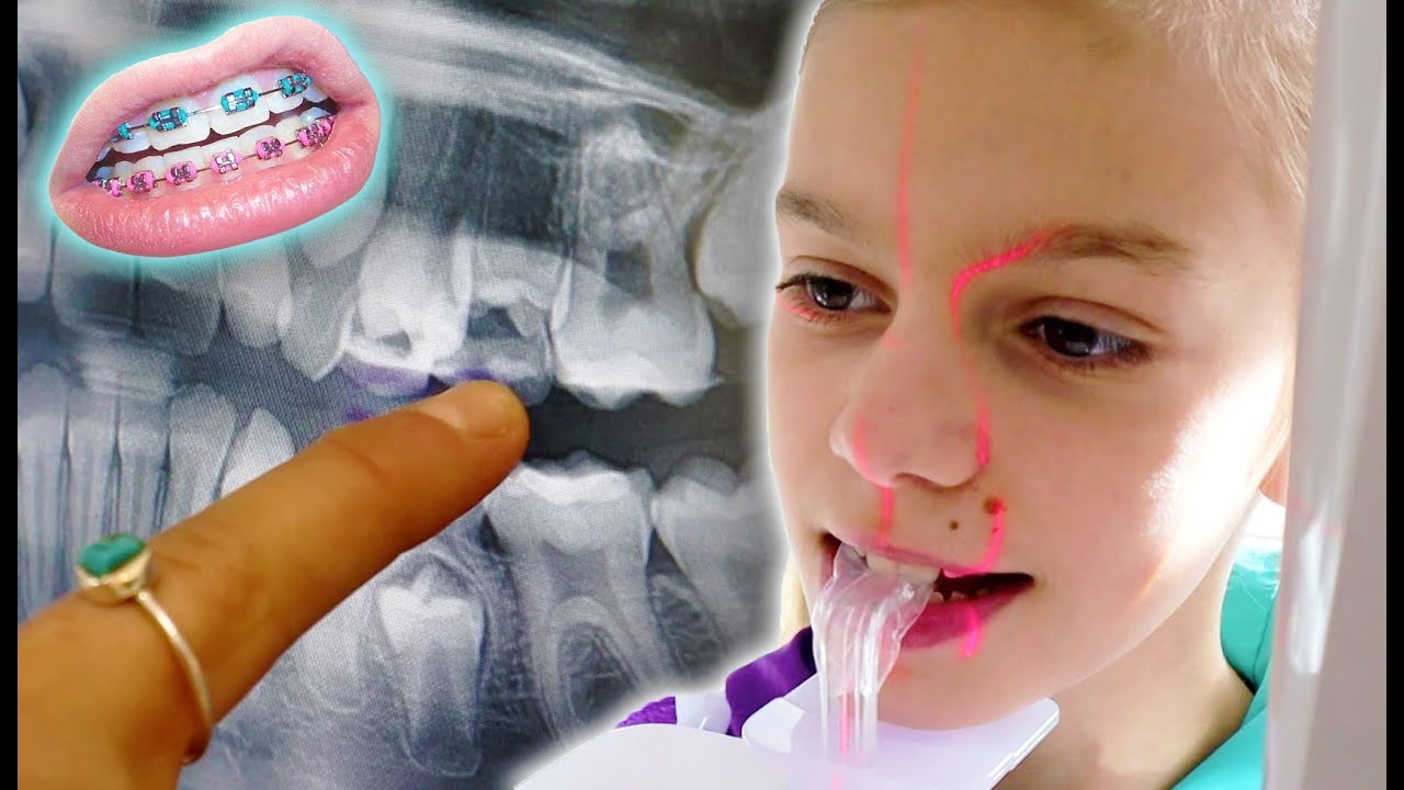 WAY Too Many Teeth! Invisalign vs Braces AGAIN! - YouTube
