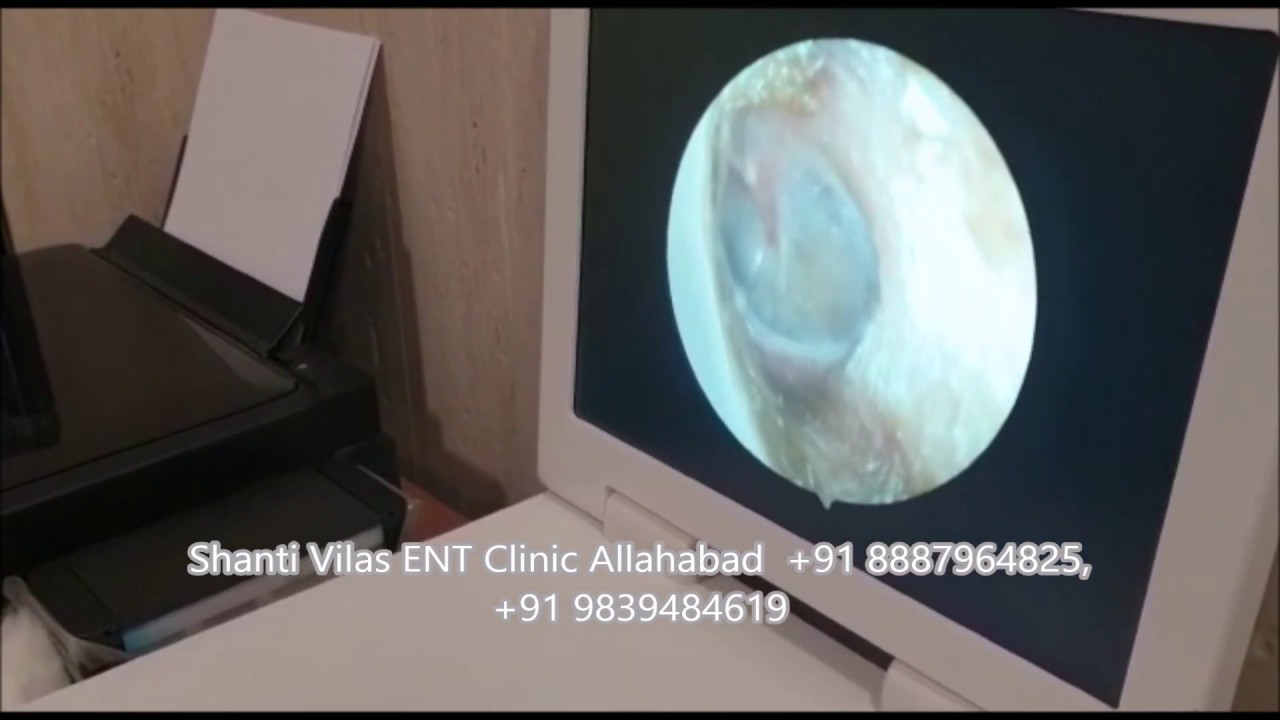Perforated Eardrum Examination - Shanti Vilas ENT Clinic Prayagraj ...