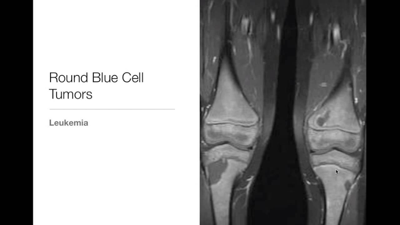 Pediatric Bone Tumors - Part 2 - YouTube