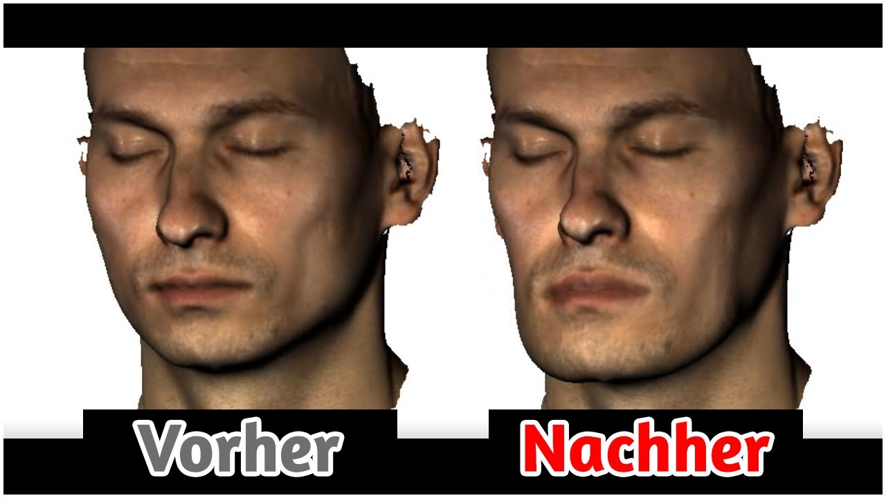 1 Monat nach BIMAX Operation 😳 "Wunderheilung" - YouTube