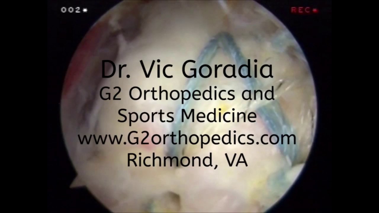 Double Row Rotator Cuff Repair Surgery - YouTube