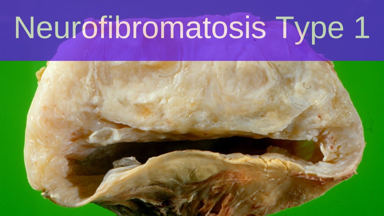 Neurofibromatosis Type 1 (NF1) - Pathology mini tutorials - YouTube