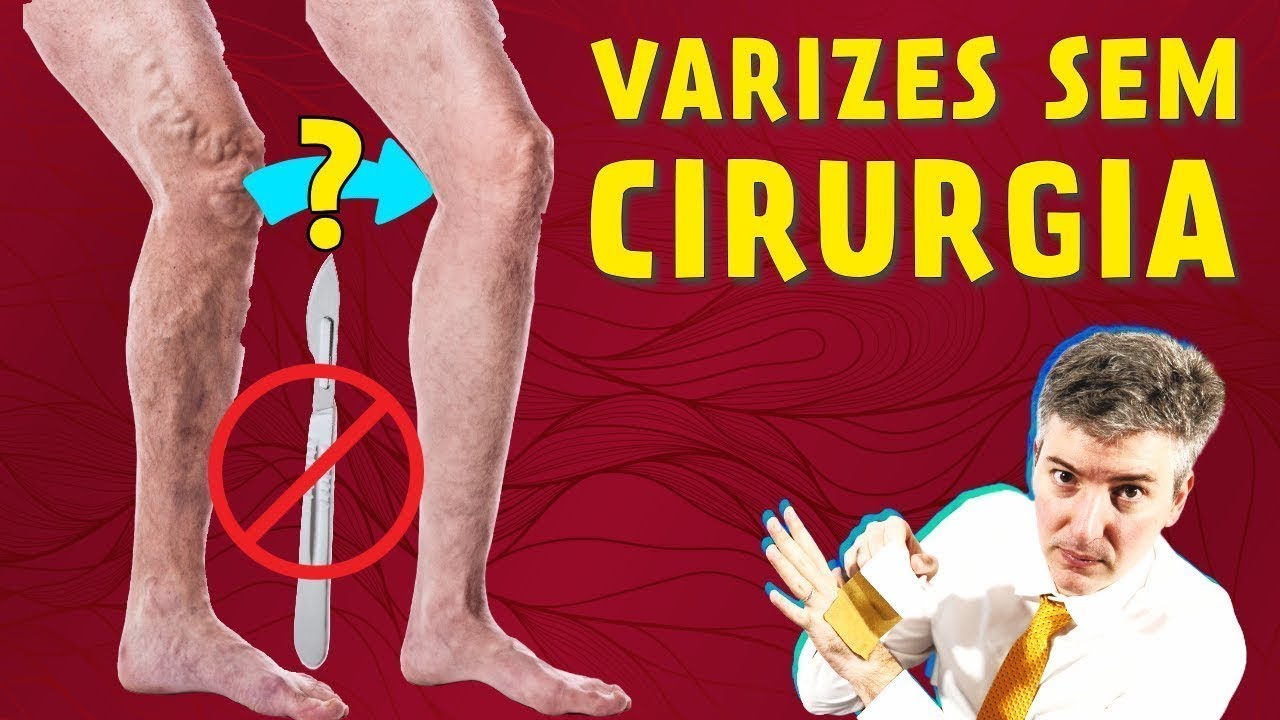 VARIZES: o Que São e Como Tratá-las SEM CIRURGIA com o Dr. Alexandre ...