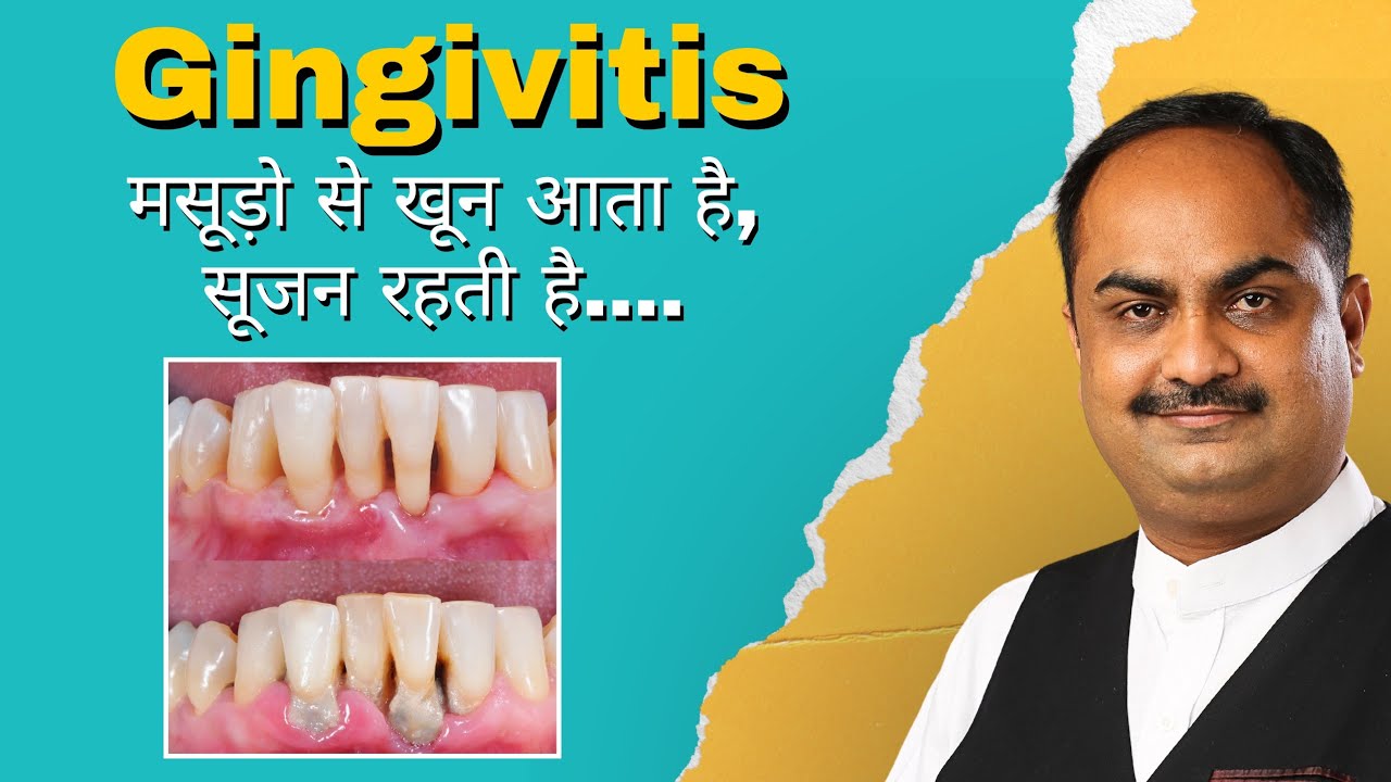 Gingivitis symptoms, causes, risk factors & treatment | Bleeding gums ...