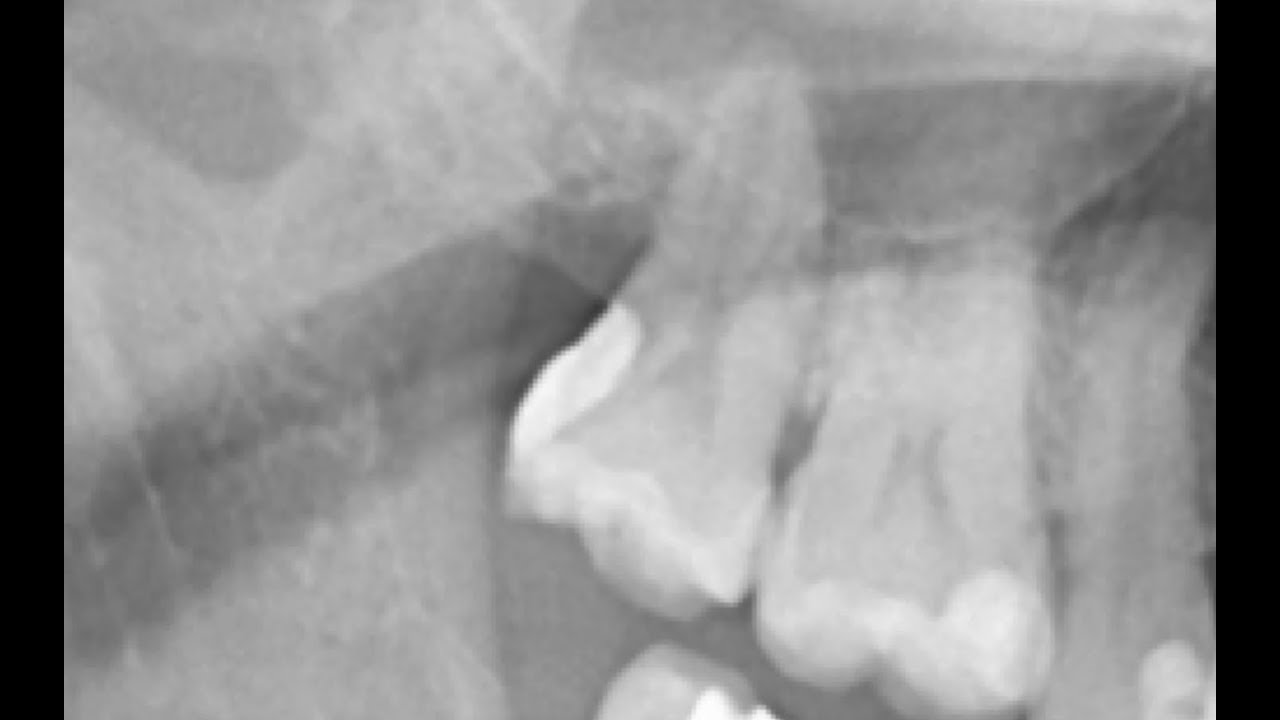 Non-surgical treatment for distal subgingival caries in the upper right ...